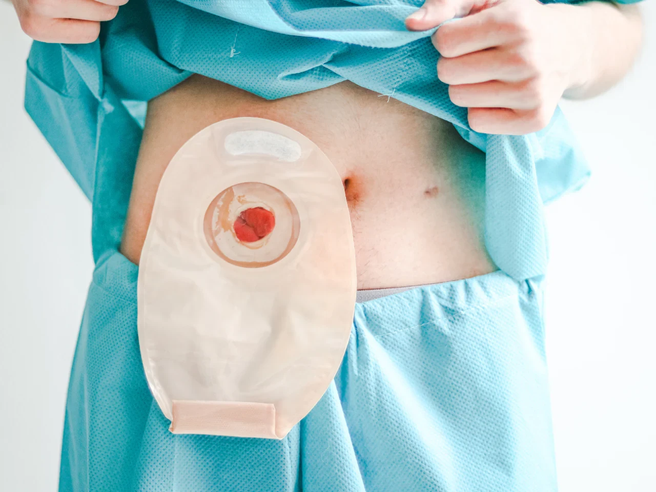 Colostomy Irrigation